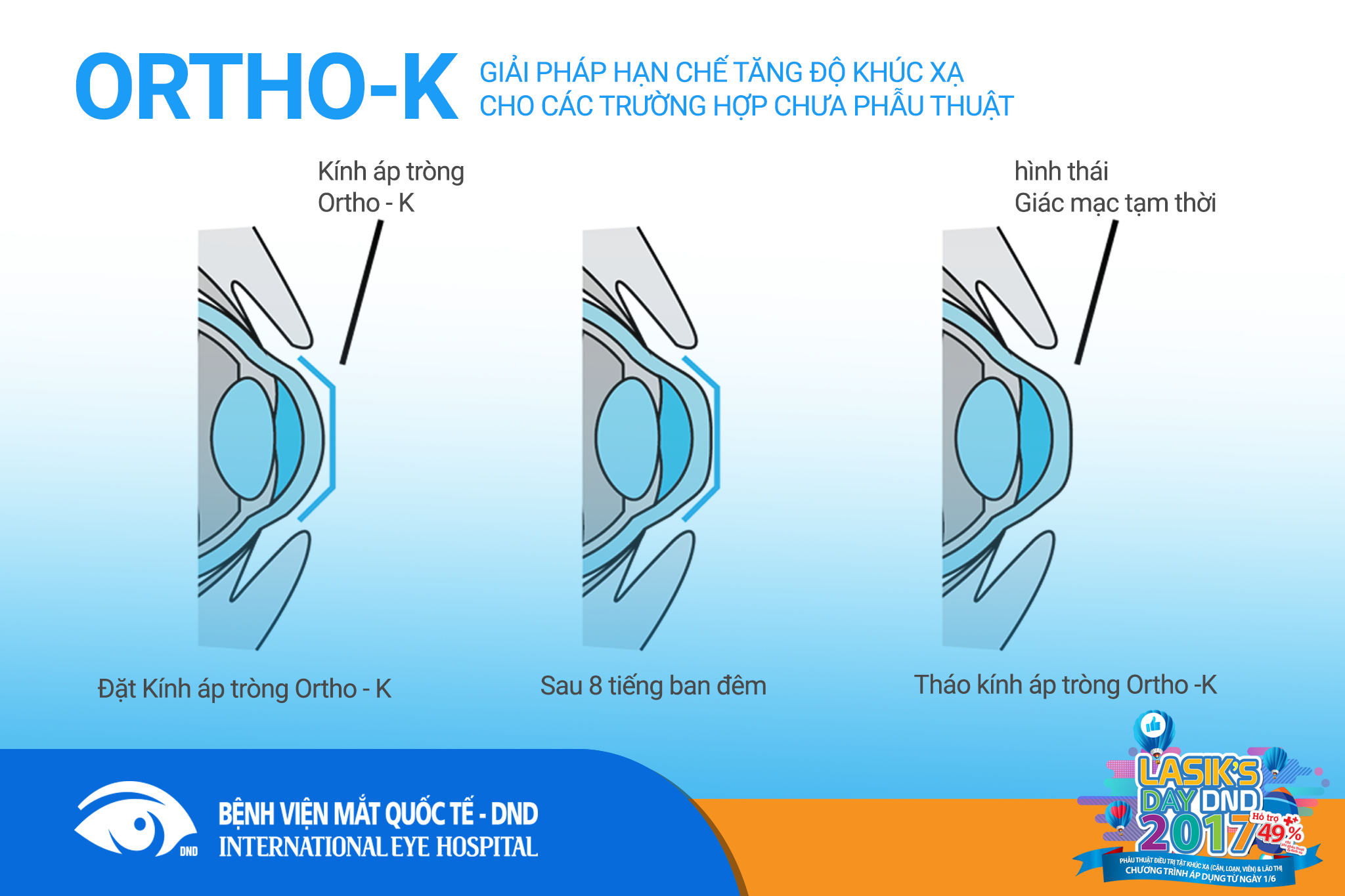 Ortho-k giải pháp hạn chế tăng độ khúc xạ cho các trường hợp chưa phẫu ...
