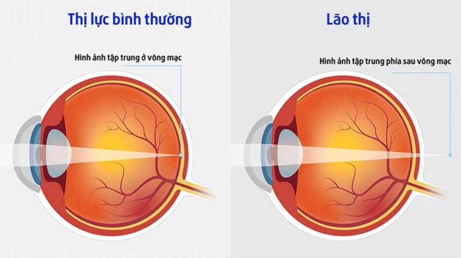 Viễn thị và lão thị giống và khác nhau như thế nào